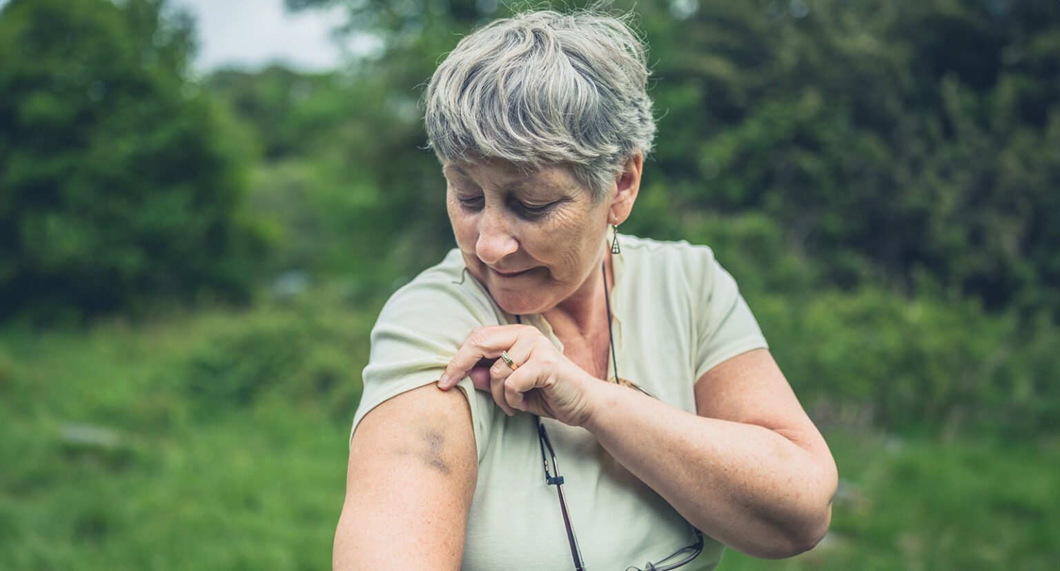 Varför får jag blåmärken så lätt? - Hemmets Journal
